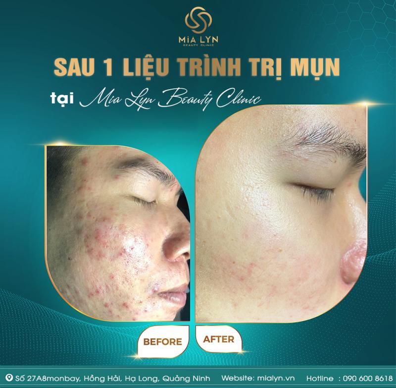 Top 5 Spa trị mụn hiệu quả nhất TP. Hạ Long, Quảng Ninh - toplist.vn
