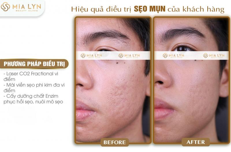 Top 5 Spa trị mụn hiệu quả nhất TP. Hạ Long, Quảng Ninh - toplist.vn